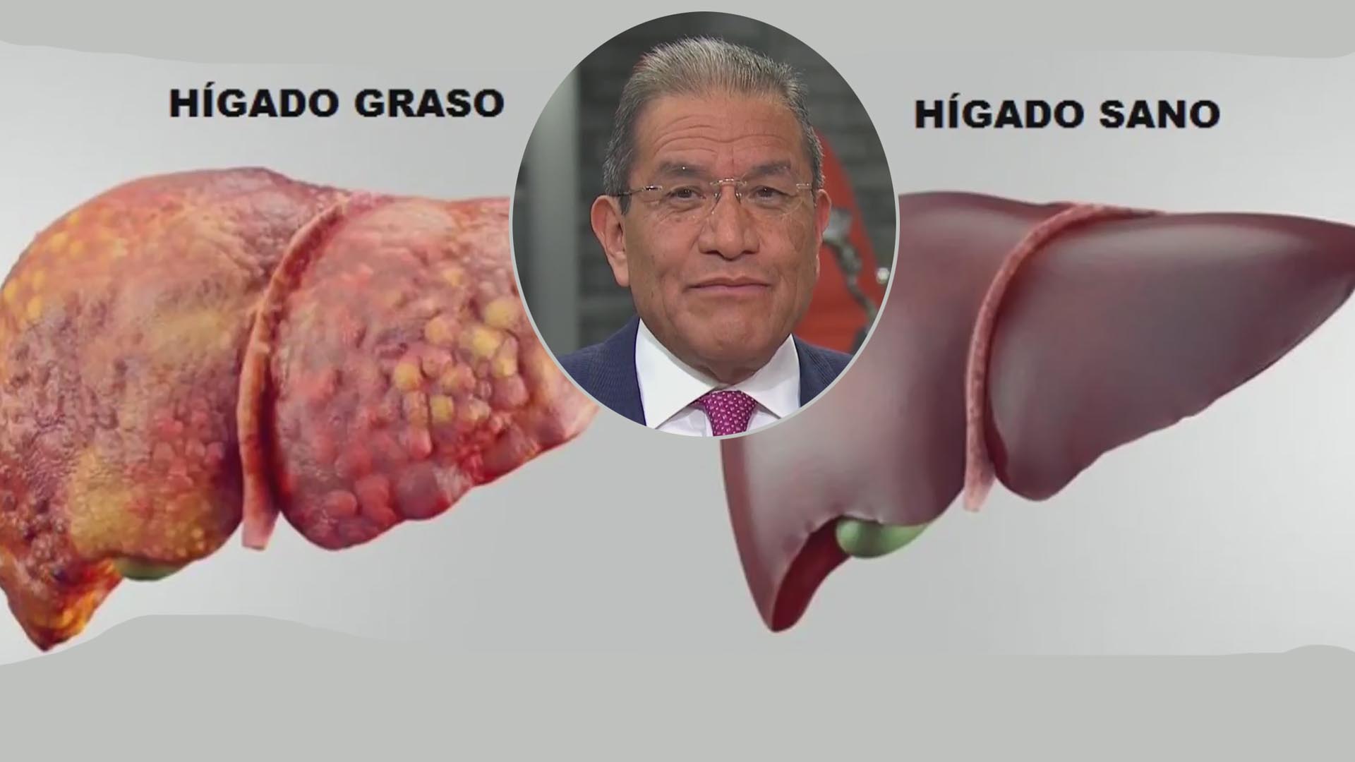 Hígado graso: qué es, cuáles son sus síntomas y riesgos de salud ...